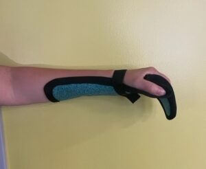 Single-use plastic splints to be replaced by woodcast alternatives in ...